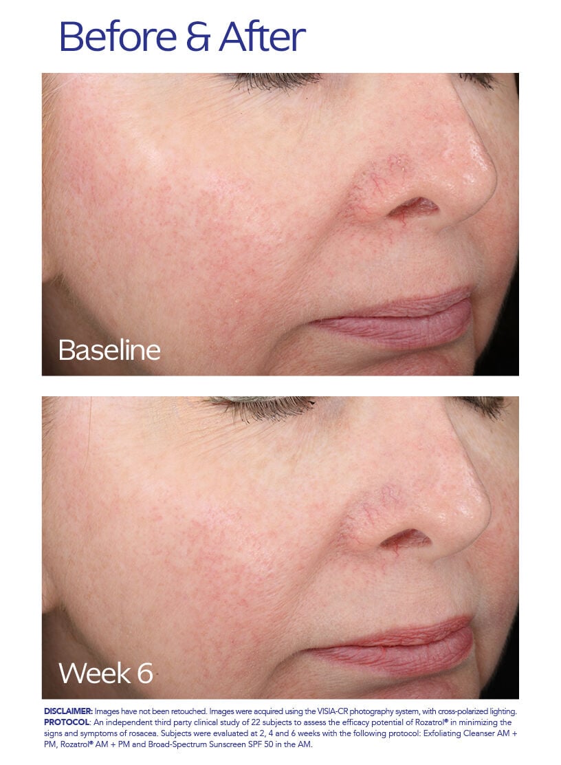 Rozatrol | Redness & Rosacea Serum | ZO Skin Health, Inc.